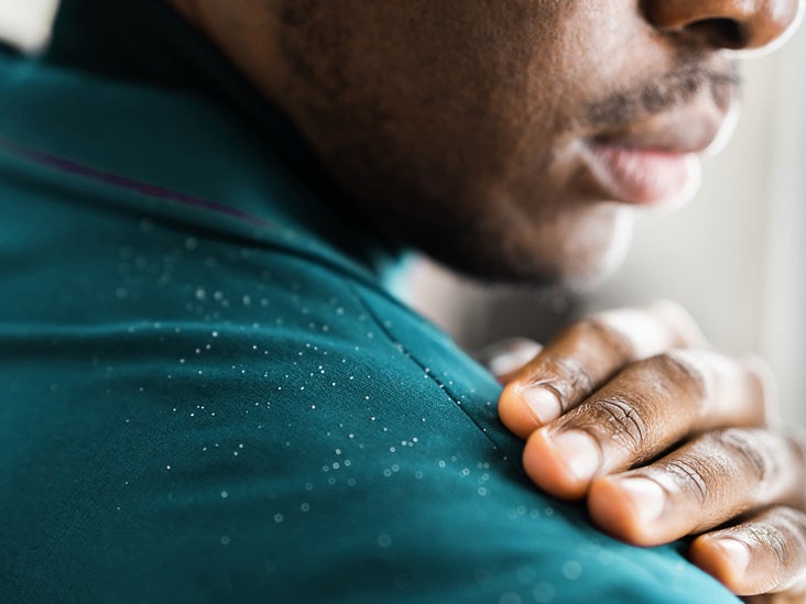 Dandruff Vs. Eczema: Causes, Symptoms, and Treatment
