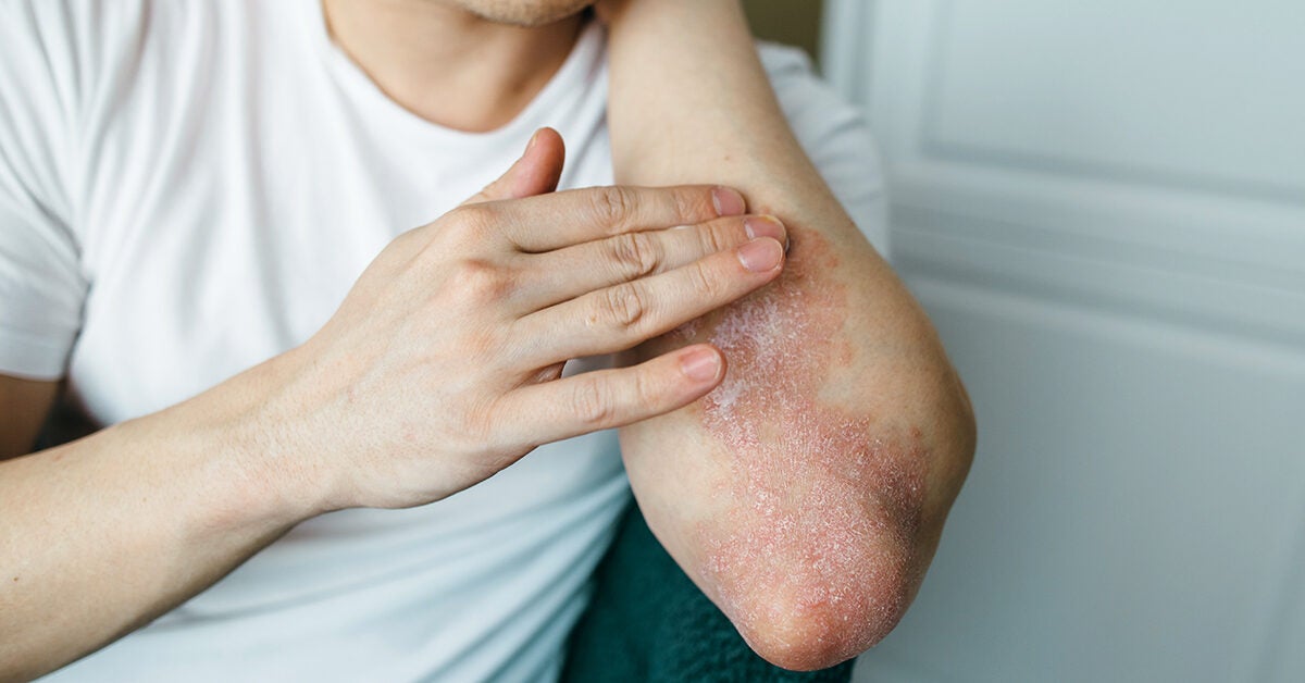 Is It Possible To Cure Psoriasis?