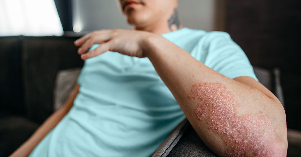 Psoriasis Impacts On Your Digestive System