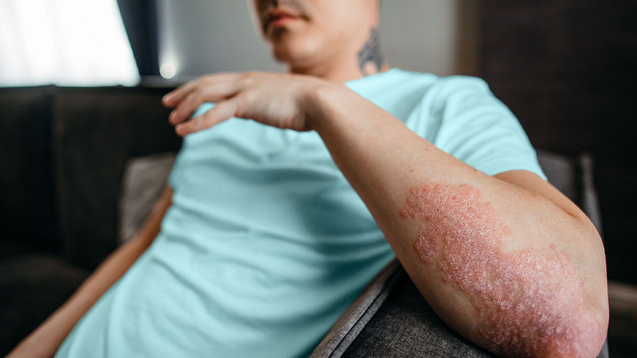 Psoriasis Impacts On Your Digestive System