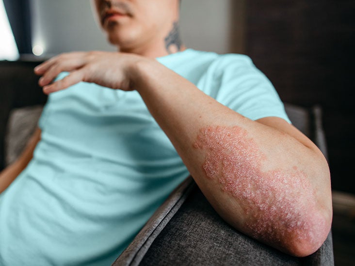 Psoriasis Impacts On Your Digestive System