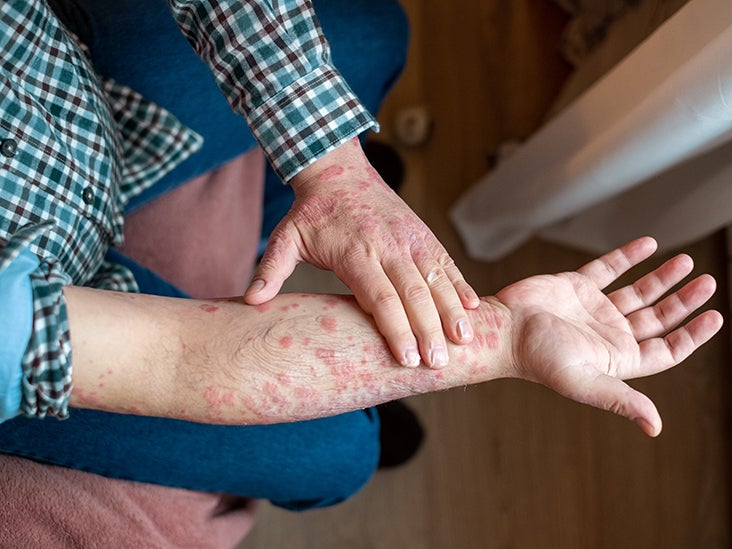 Psoriasis and Rheumatoid Arthritis: Are They Connected?