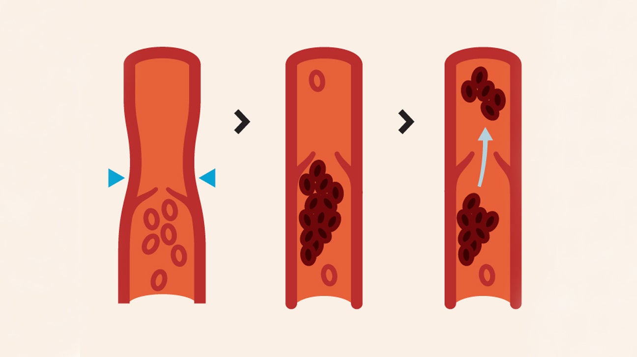 Deep Vein Thrombosis (DVT): Symptoms, Causes, and More