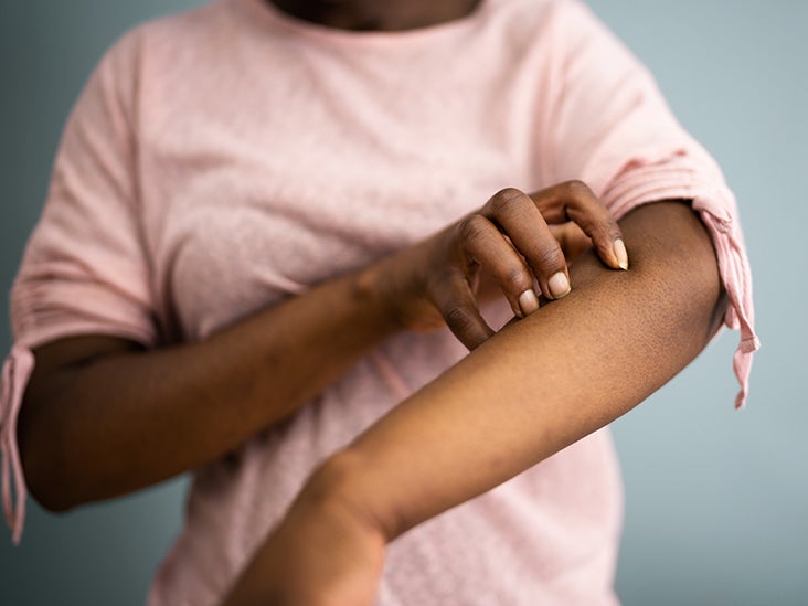 What Causes Nodular Prurigo? Underlying Conditions and More