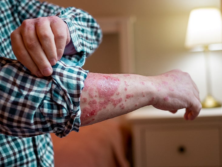 How to Track Your Psorasis Symptoms: Logs and More