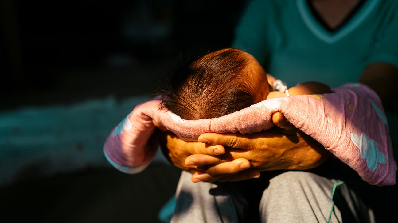 Beckwith-Wiedemann Syndrome: Symptoms, Diagnosis, and Effects