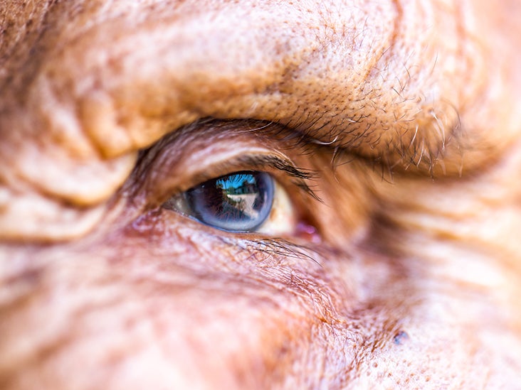 Cortical Cataract: Causes, Symptoms, Treatment, and More