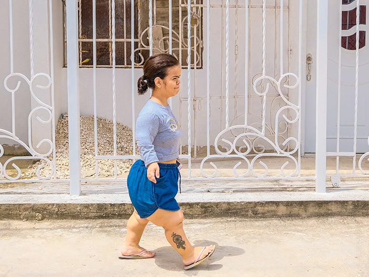 Diastrophic Dysplasia Cause, Signs, Diagnosis, and Treatment