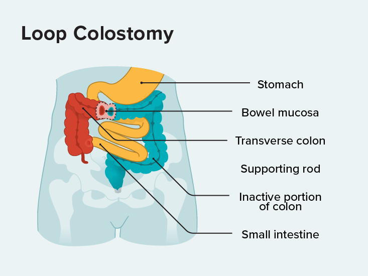 Ileostomy Pictures