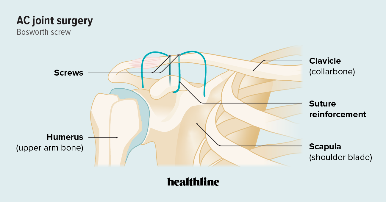 AC Joint Surgery: Types, Costs, and Recovery