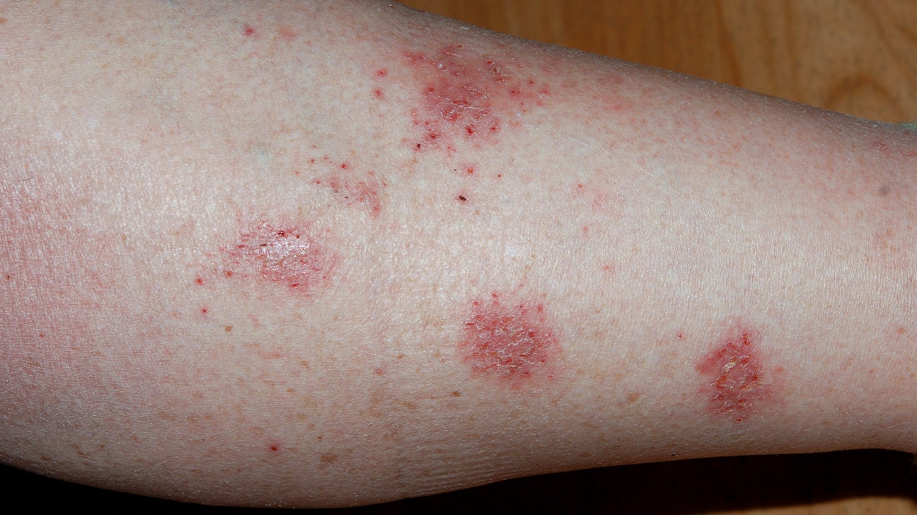 Eczema In Pictures What Do The Types Look Like 46 OFF Eczema In Pictures What Do The Types Look Like 46 OFF