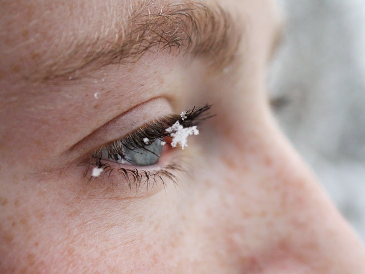 Dry Eyes in Winter: Causes, Treatment, and Prevention