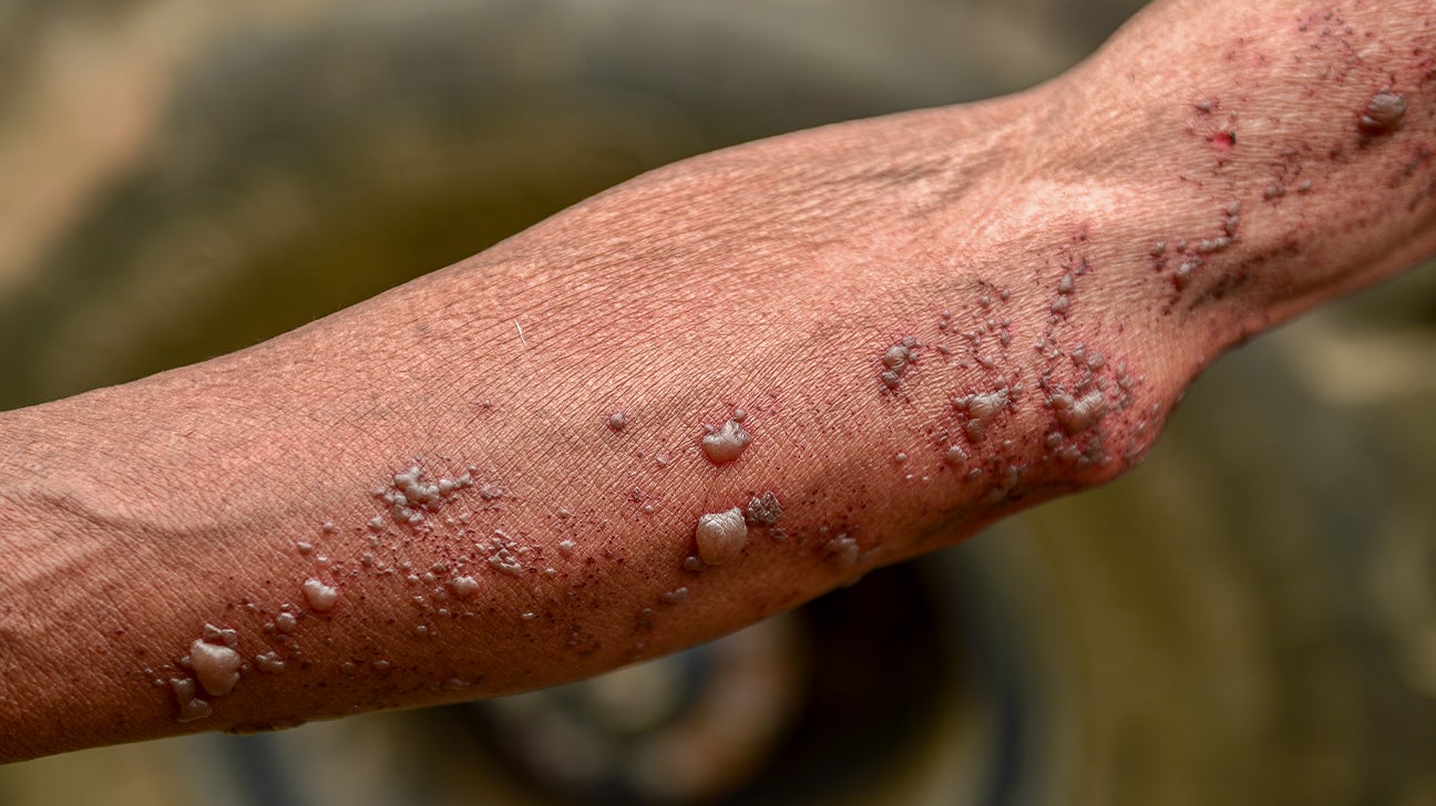 Rash 22 Common Skin Rashes Pictures Causes Treatment 56 Off