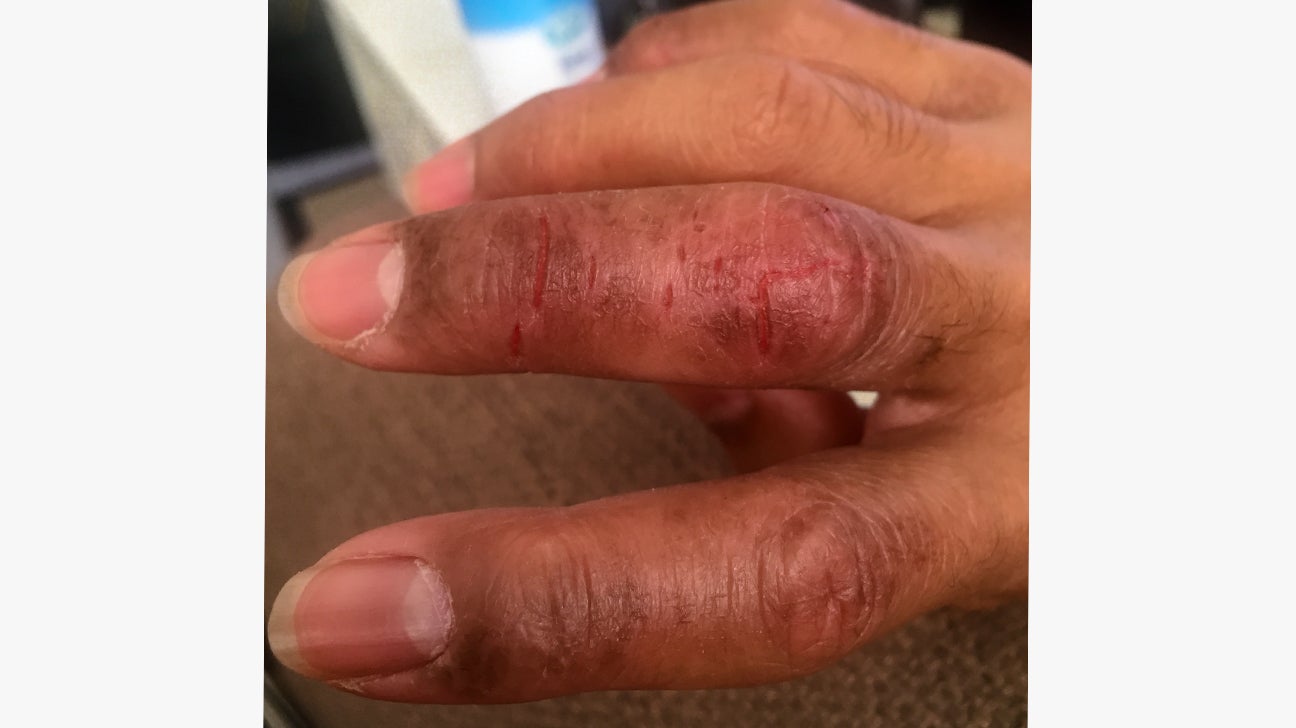 Blisters: Pictures, Causes, and Outlook