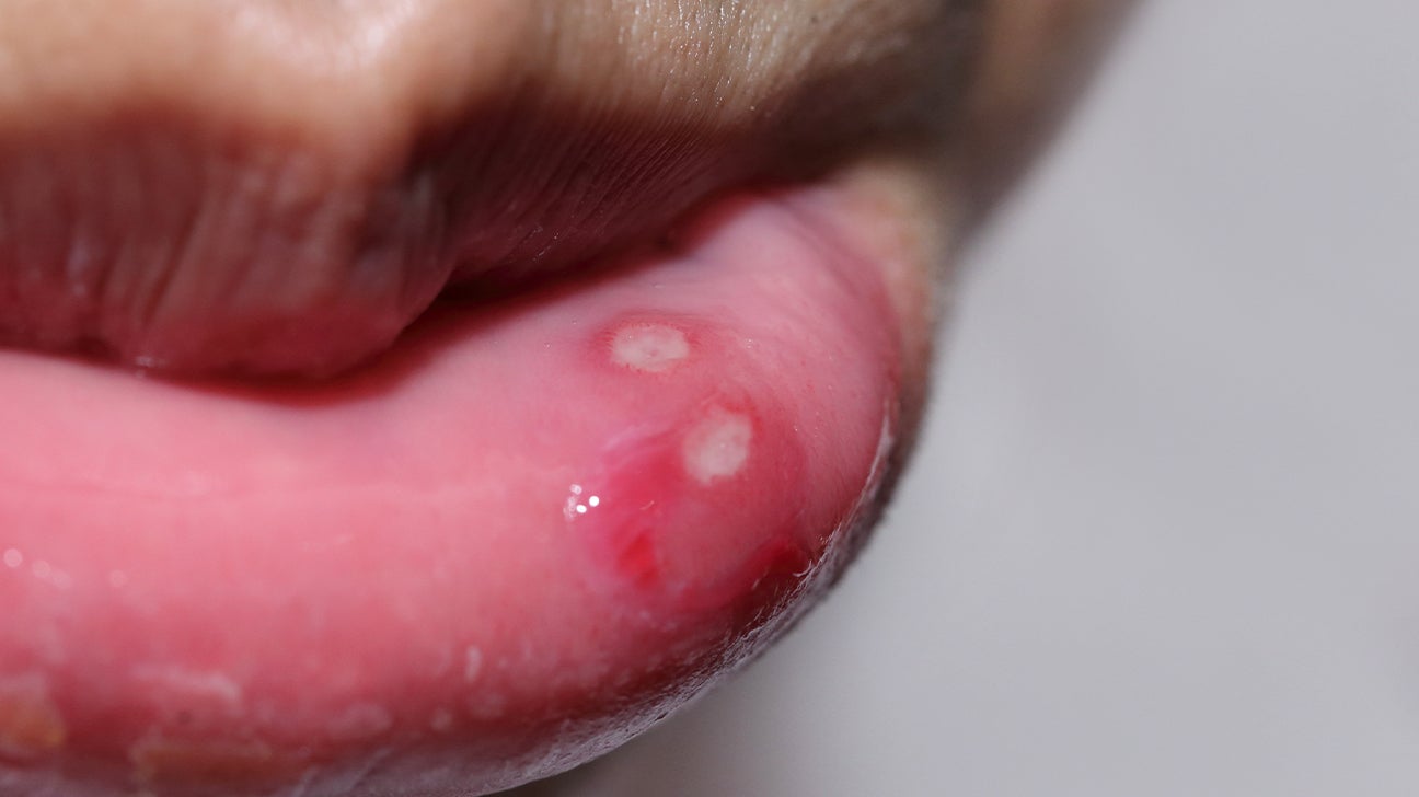 Blisters: Pictures, Causes, and Outlook