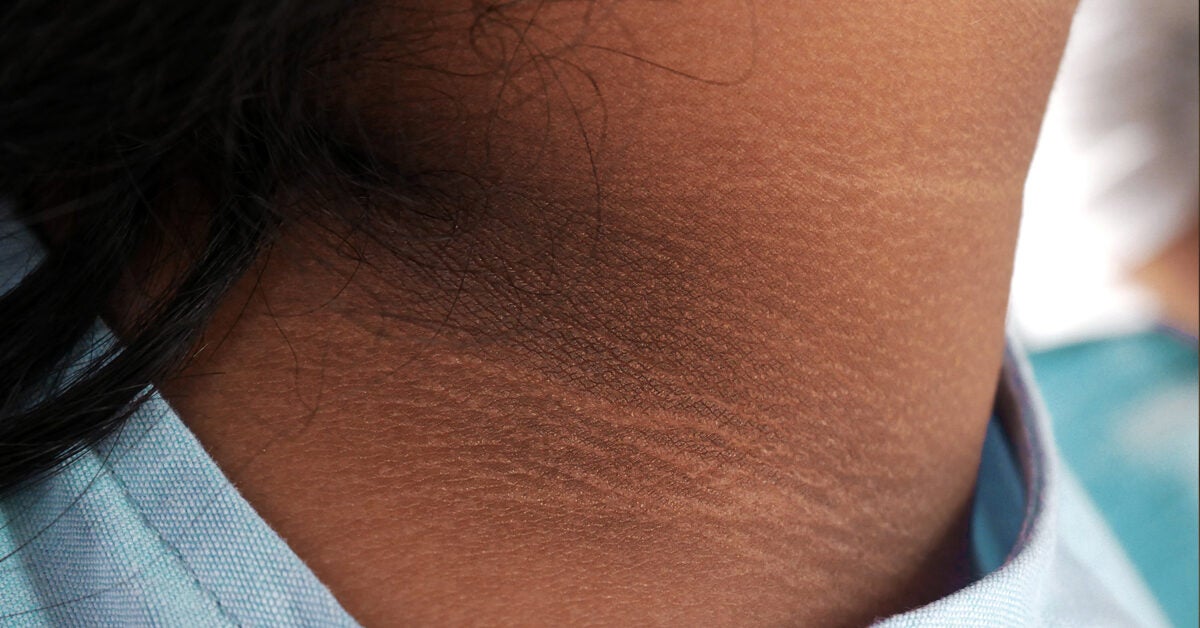 Obesity And Skin Problems Rashes Itching Odors And More Obesity And Skin Problems Rashes Itching Odors And More