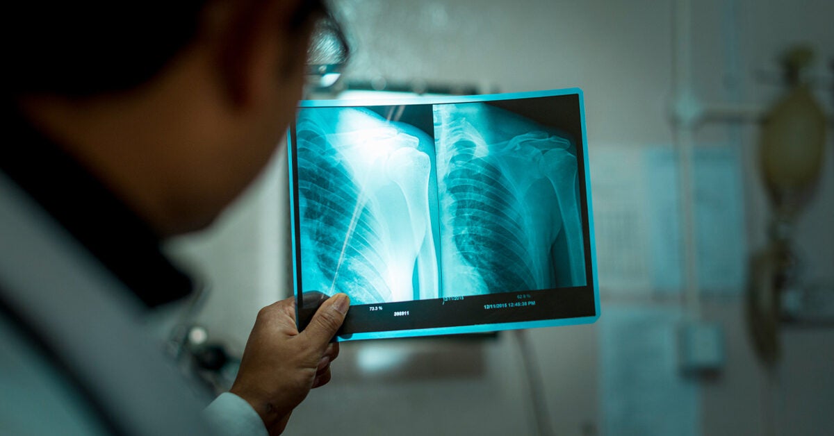 Primary Bone Lymphoma: Symptoms, Diagnosis, Treatment, Outlook