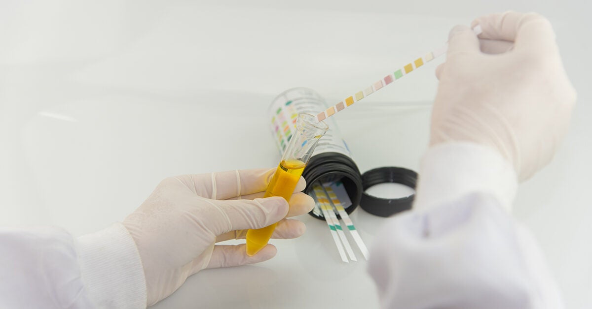 Urine Protein-Creatinine Ratio Test: What It Measures, Levels