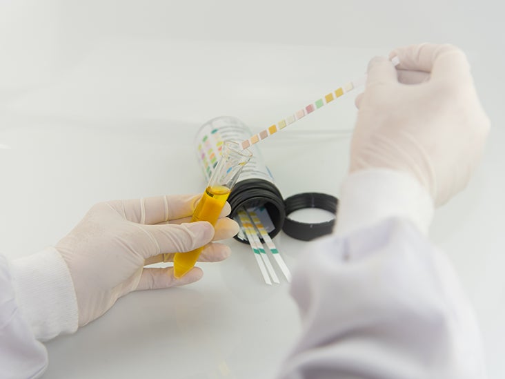 Urine Protein Creatinine Ratio Test Cost at Bev Wood blog