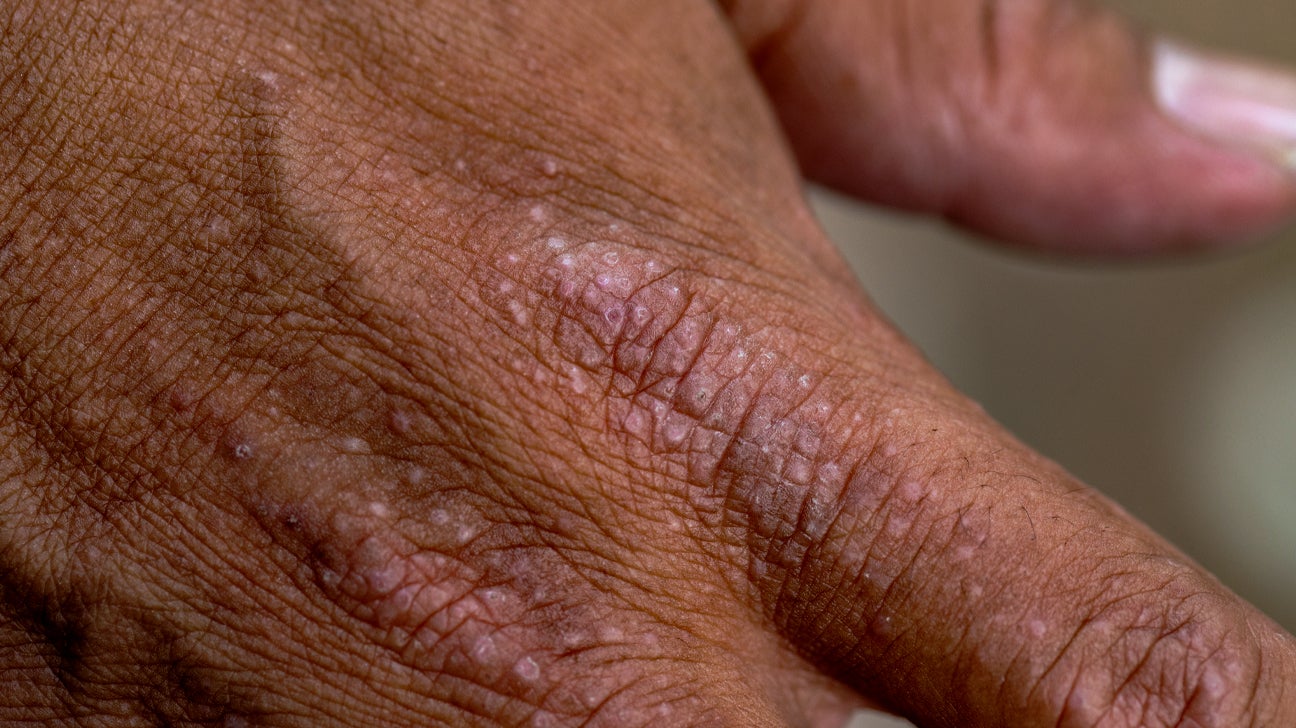 White Spots On the Skin: Possible Causes and Treatments