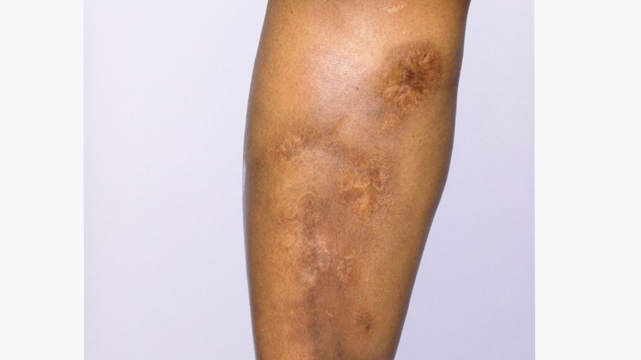 White Spots On the Skin: Possible Causes and Treatments