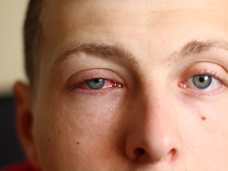 Pink Eye and Blindness: What You Should Know