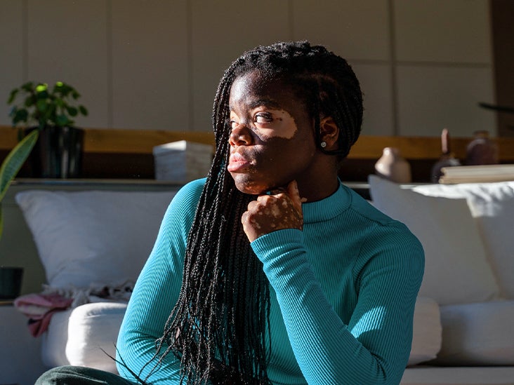 How Vitiligo Progresses: Your FAQs