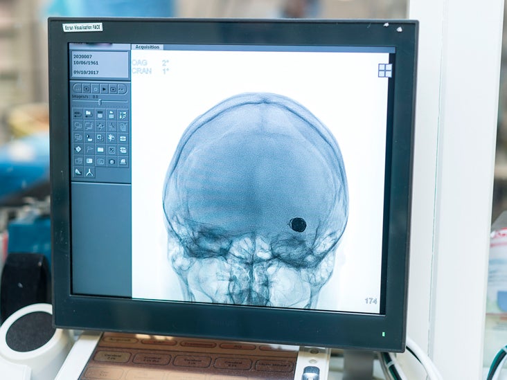 Life After A Brain Aneurysm Long Term Effects And Recovery