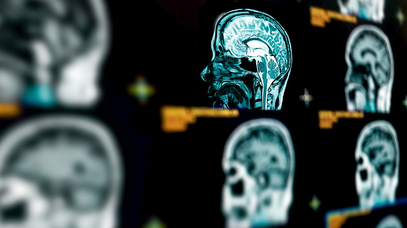 Types of Brain Cancer: A Comprehensive List