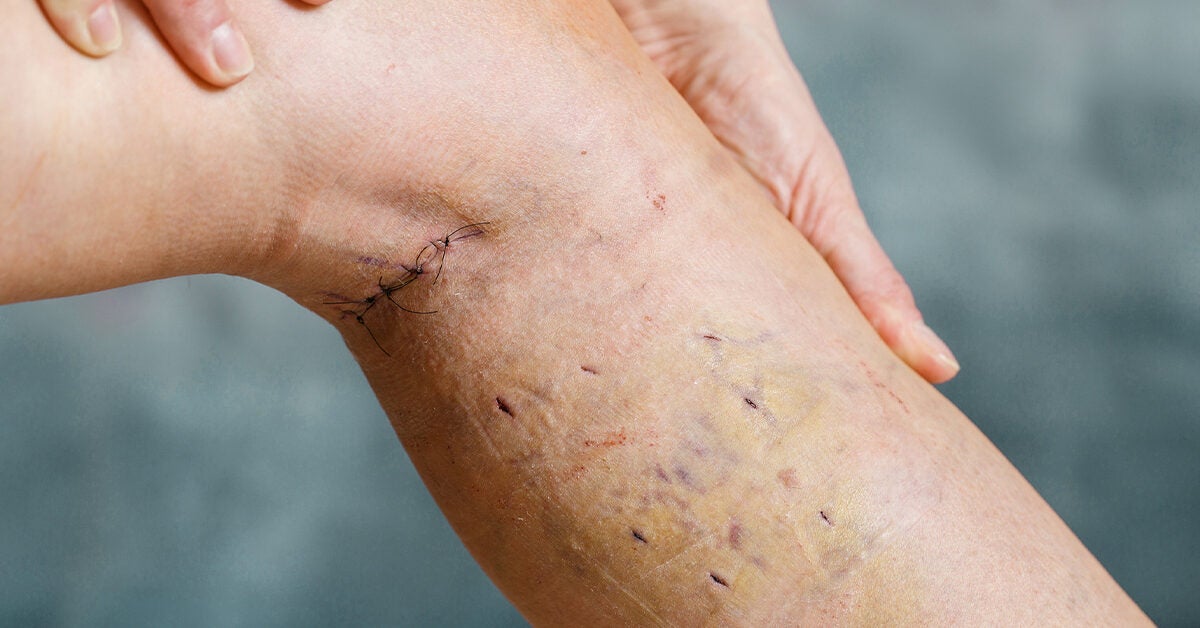 Ambulatory Phlebectomy for Varicose Veins: What to Expect