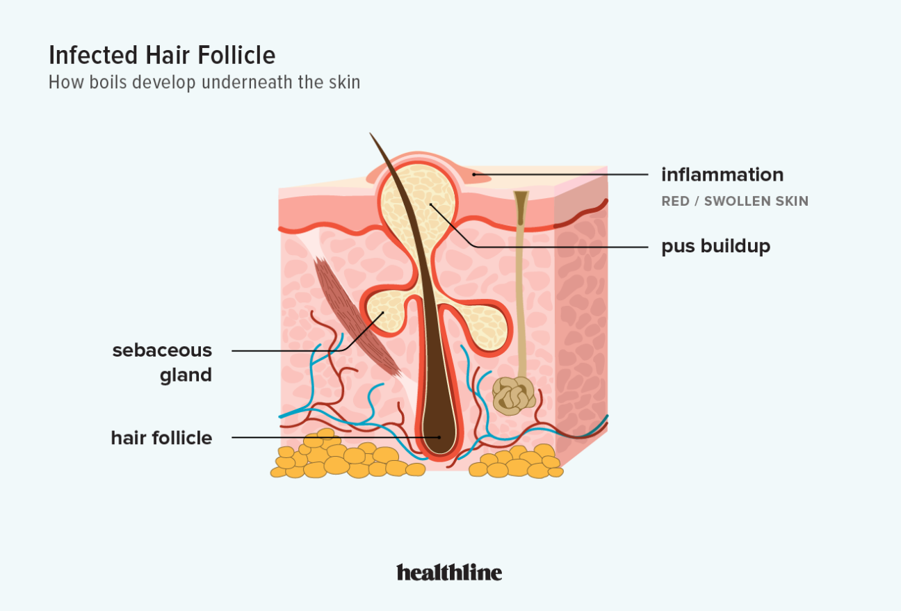 Razor Bump Diagram