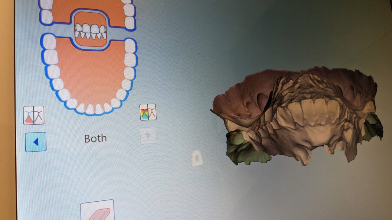 A Hands-On Review of SmileDirectClub