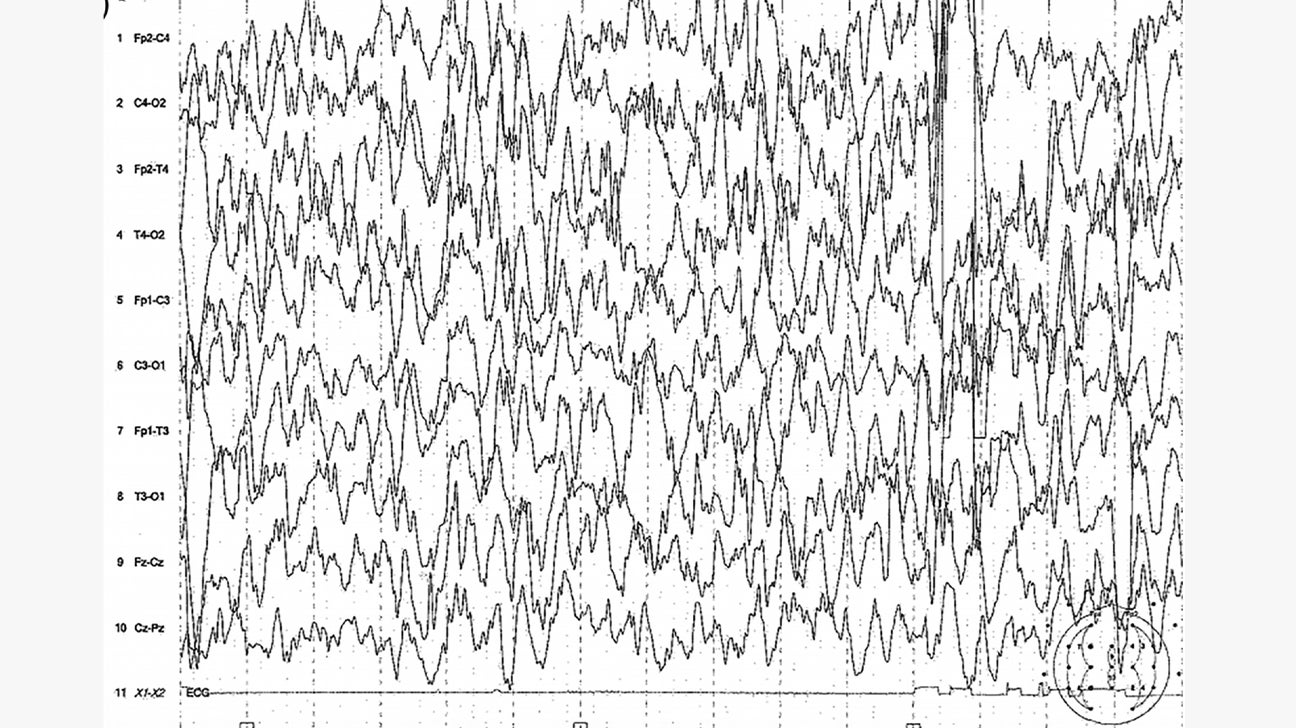 Hypsarrhythmia on an EEG: What to Know