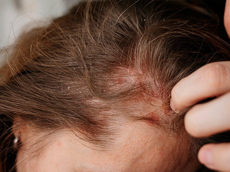 Mild Psoriasis: Photos, Symptoms, and More