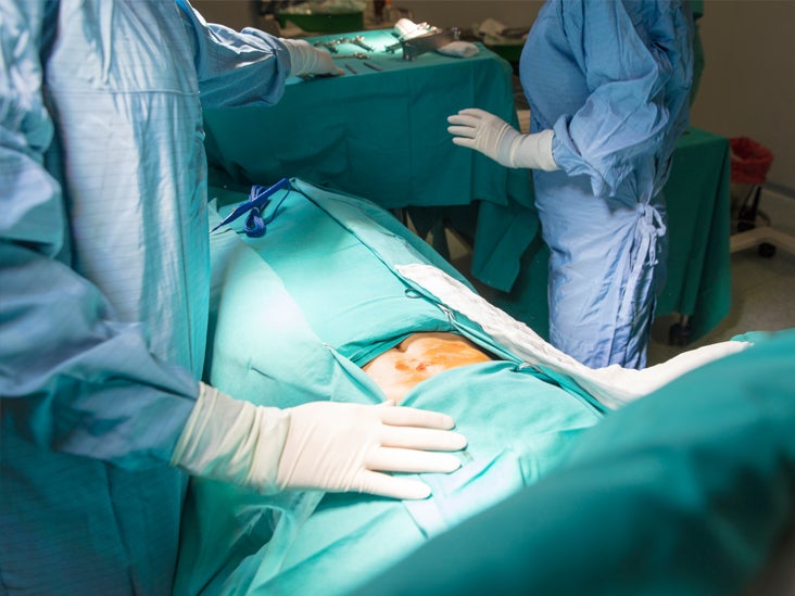 Ovarian Cancer Omentectomy: When Needed, What to Expect