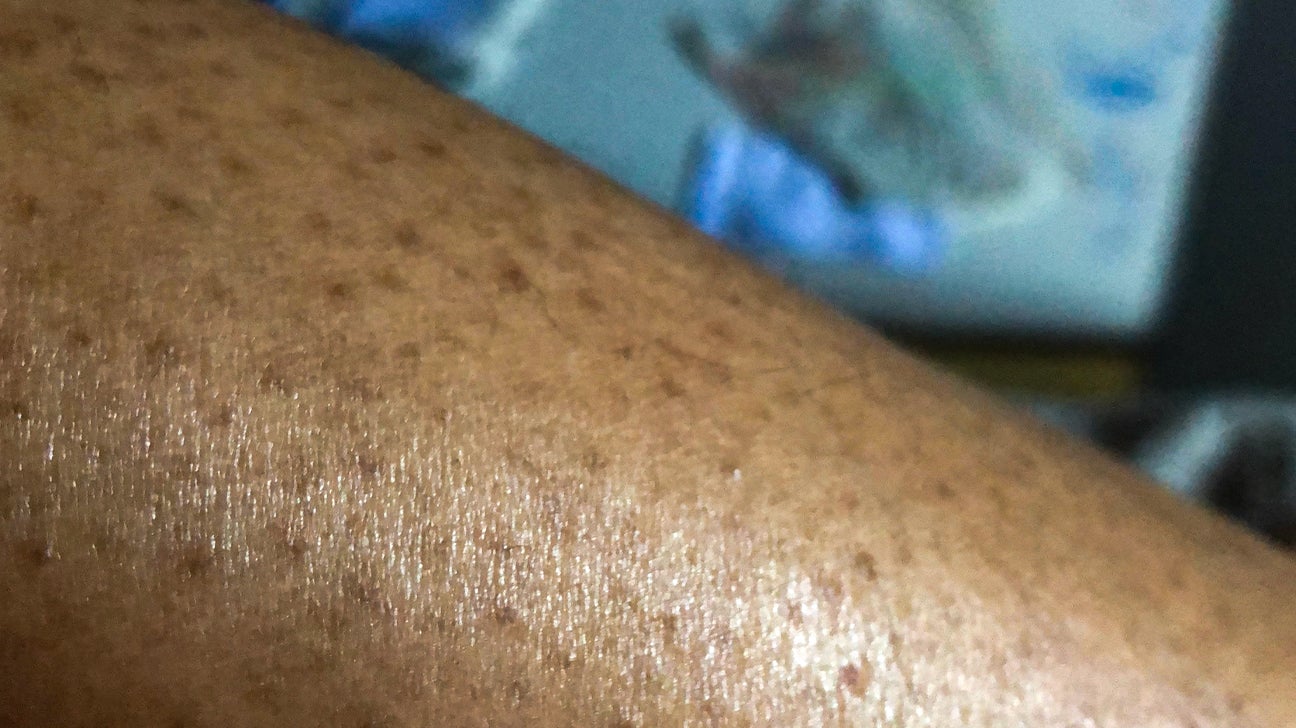 Raised Skin Bumps: Pictures, Types, Causes, and Treatment