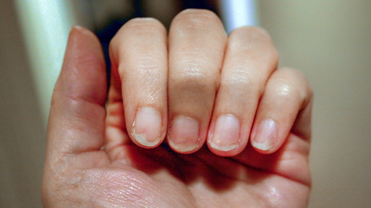 Mild Psoriasis Pictures Types And Symptoms