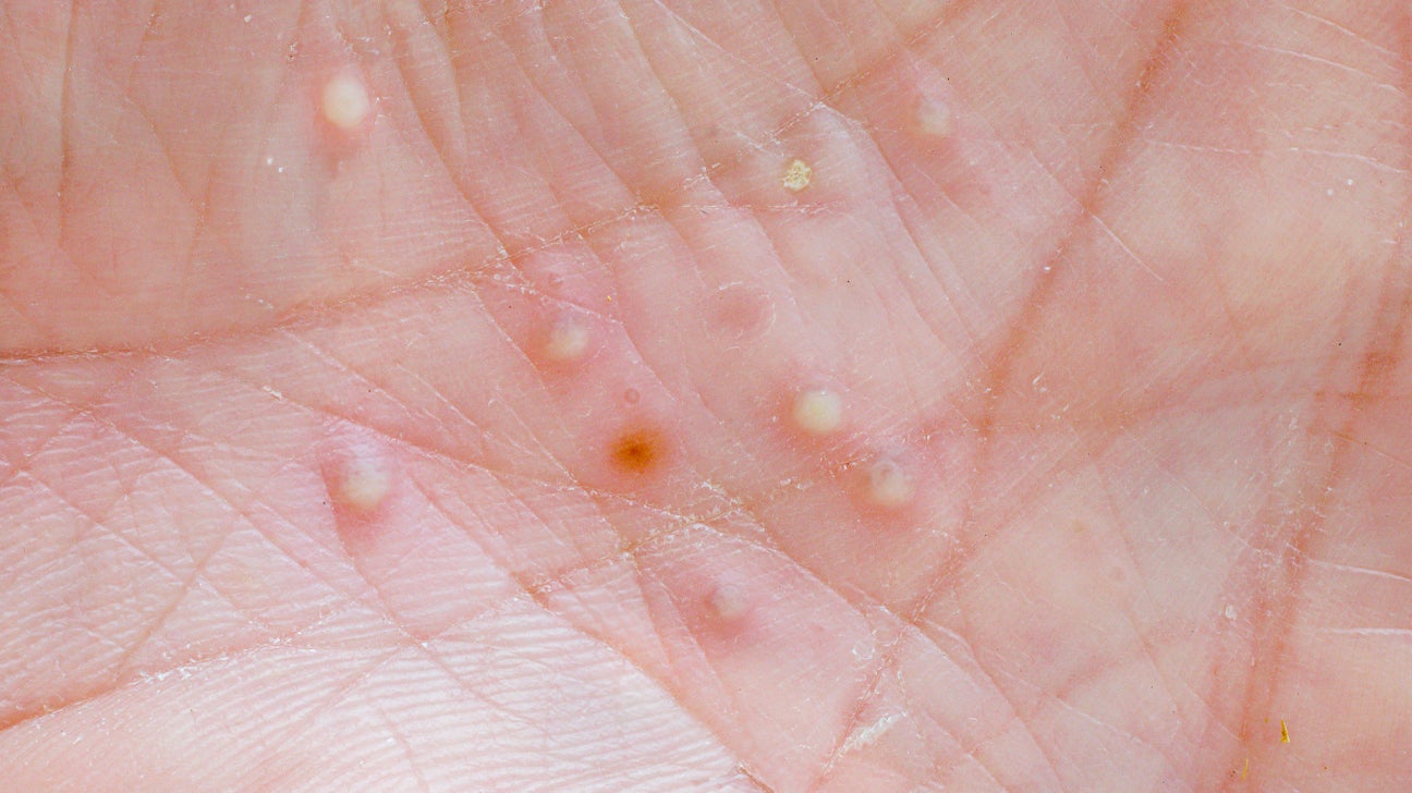 Mild Psoriasis: Pictures, Types, and Symptoms