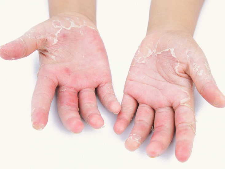 Joint Pain Feet Lupus at Pamela Beeler blog