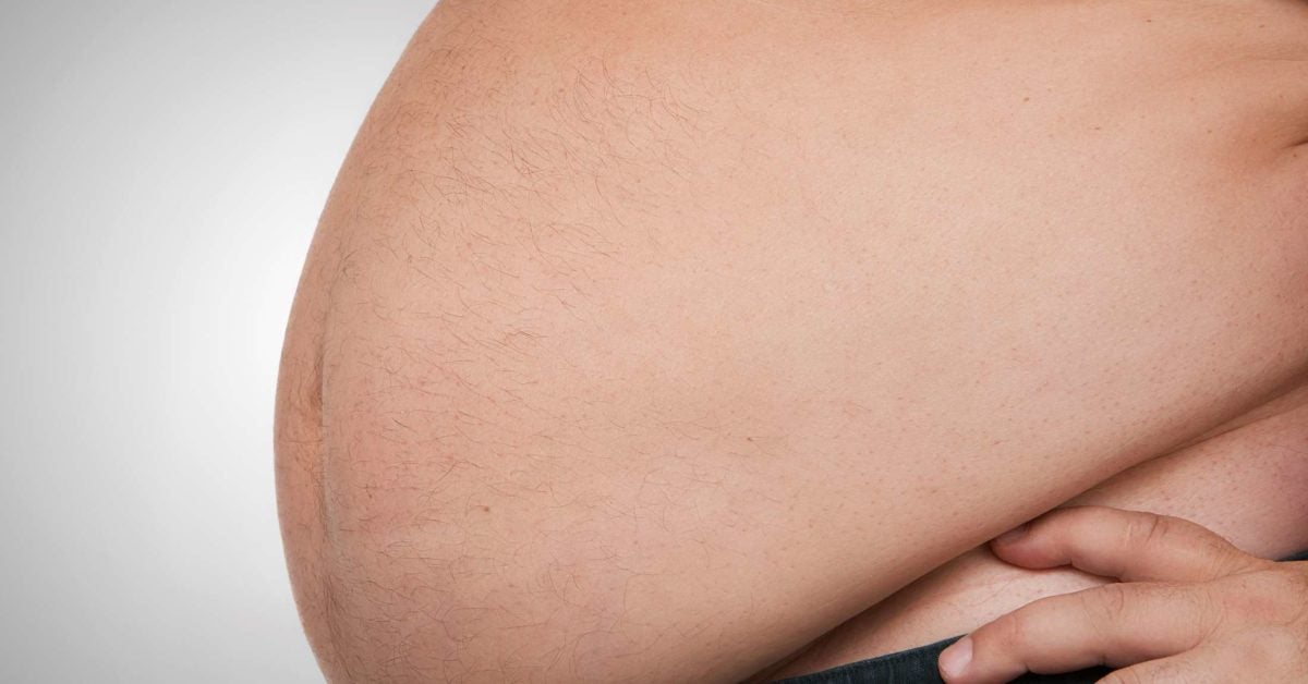 Morbid Obesity Symptoms Treatment And Outlook