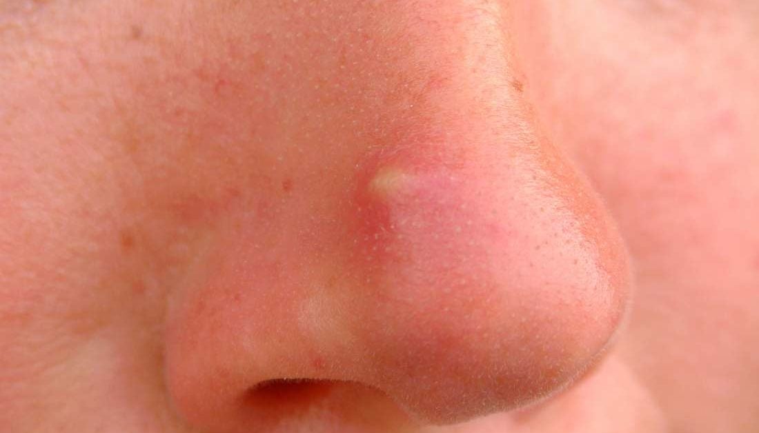 Nose Tingle Sensation Nose Tingle Sensation