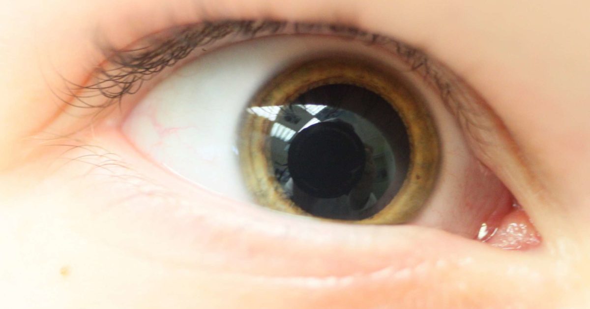 Mydriasis Causes And Treatment For Dilated Pupils Mydriasis Causes And Treatment For Dilated Pupils