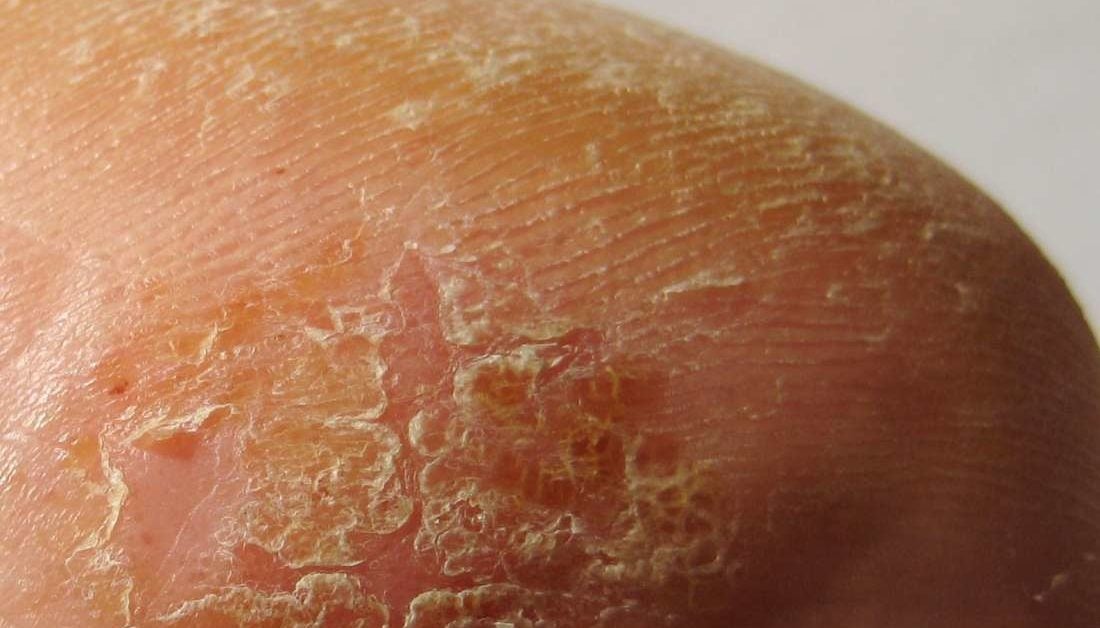 Scaling Skin Pictures Causes Treatment And Prevention Scaling Skin Pictures Causes Treatment And Prevention