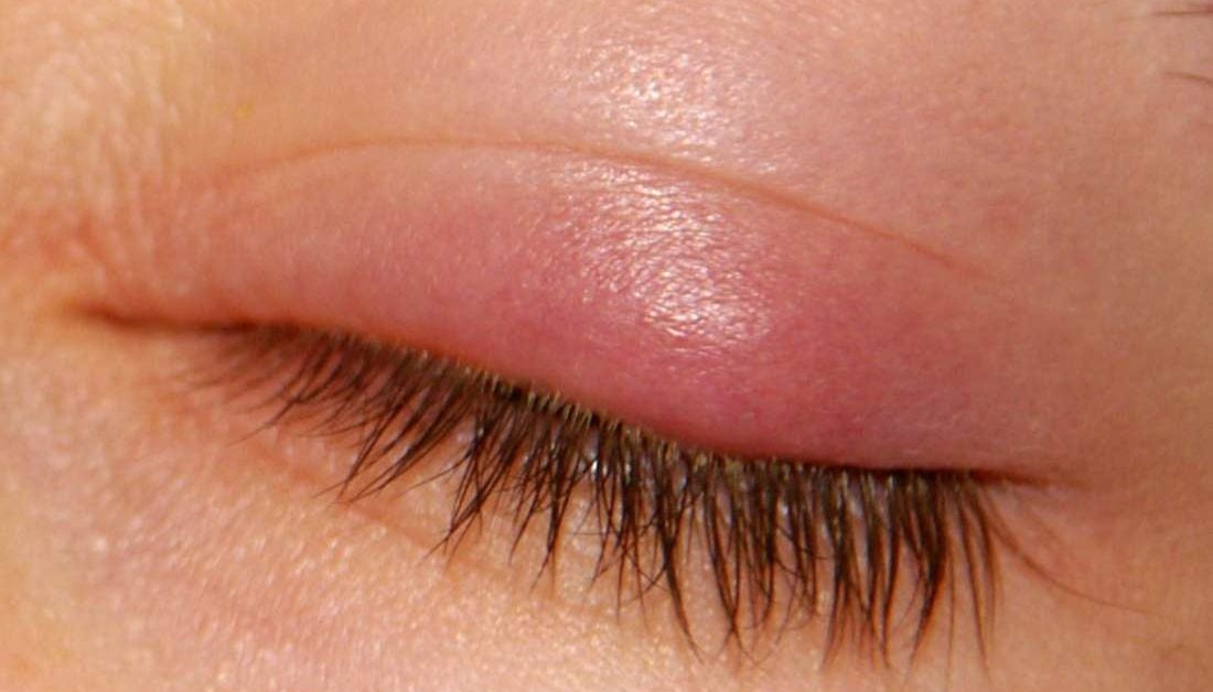 Chalazion Pictures Causes And Treatment Chalazion Pictures Causes And Treatment