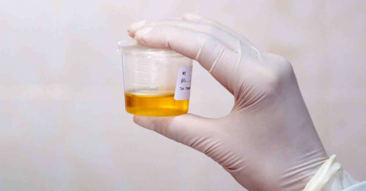 Cortisol Urine Test Uses Procedure And Results Cortisol Urine Test Uses Procedure And Results