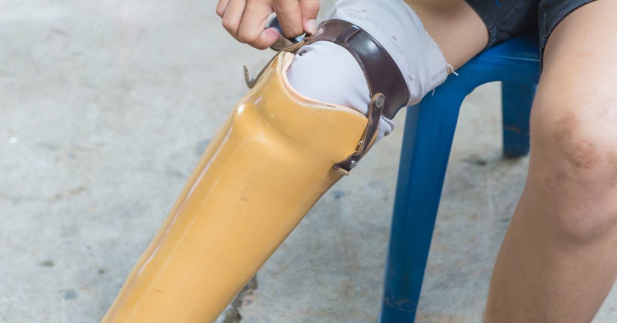 Diabetes and amputation: What to know