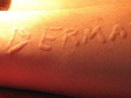 Dermatographia: Causes and treatment of skin writing