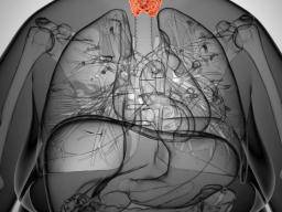 Hyperthyroidism: Causes, symptoms, and treatment