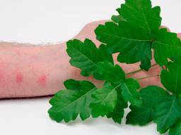 Poison oak rash: Photos and treatment options