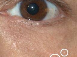 Syringoma: Pictures, treatment, and removal
